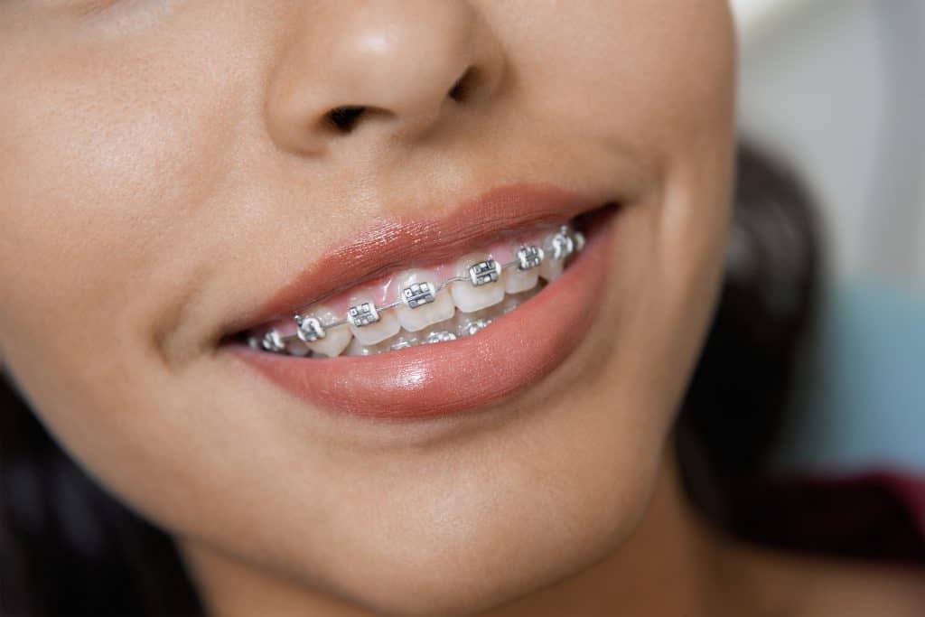 How to reduce the pain of braces | Larry D. Molenda, D.D.S.
